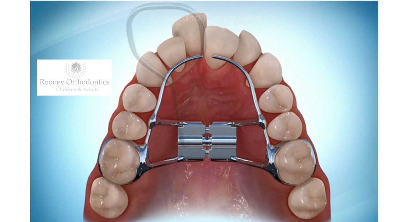 Types of Appliances - Dr. Sean M. Rooney Children & Adult Orthodontics ...